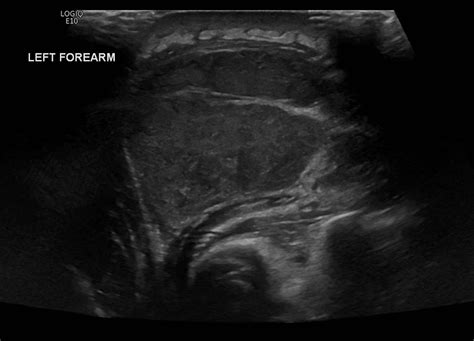 Forearm Inflammatory Intramuscular Collection Sonohive