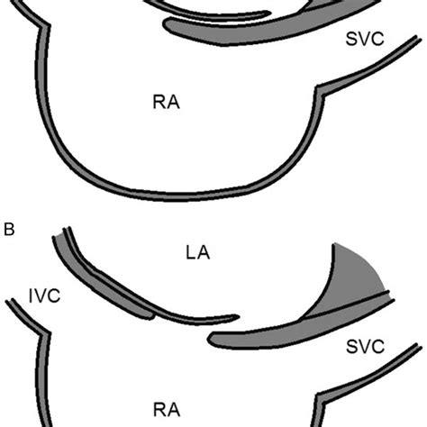 Tee In The 90 Degree Bicaval View Showing A Long Tunnel Pfo In The