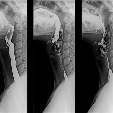 Fluoroscopy Barium Swallow Barium Meal Small Bowel Enema