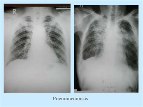 Ppt Ilo 1980 International Classification Of Radiographs Of The Pneumoconioses Powerpoint
