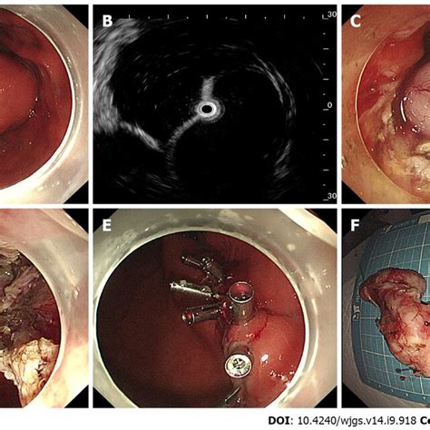 Case Illustration Of Endoscopic Full Thickness Resection A Endoscopic