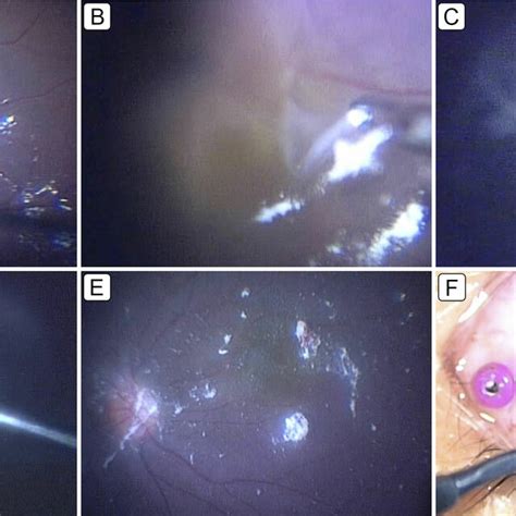 Intraoperative Surgeons View Of 27 Gauge Microincision Vitrectomy