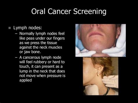 Swollen Lymph Nodes Under Jaw