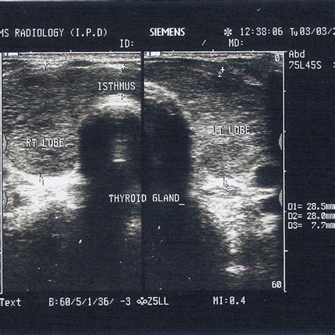 Usd Thyroid Showing Diffuse Enlargement Of The Thyroid Download Scientific Diagram