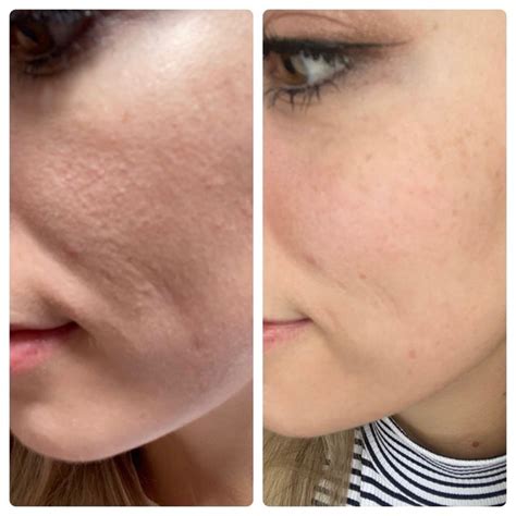 How To Get Rid Of Large Pores And Fine Lines Using Microneedling