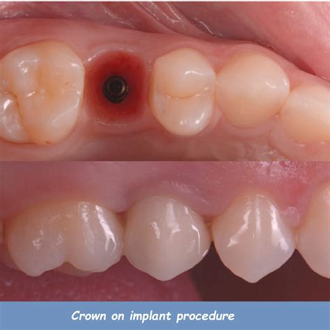 Crown On Implant Procedure