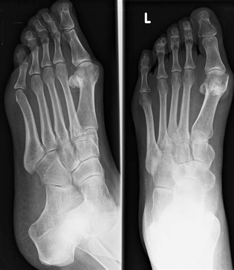 Figure 2 From Misdiagnosis Of Extraskeletal Osteochondroma In The Foot