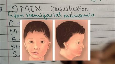 Omens Classification Of Hemifacial Microsomia Youtube