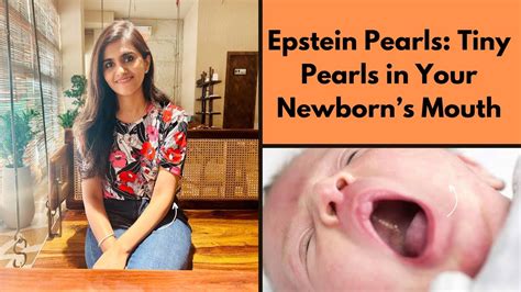 Epstein Pearls Tiny Pearls In Your Newborns Mouth Youtube