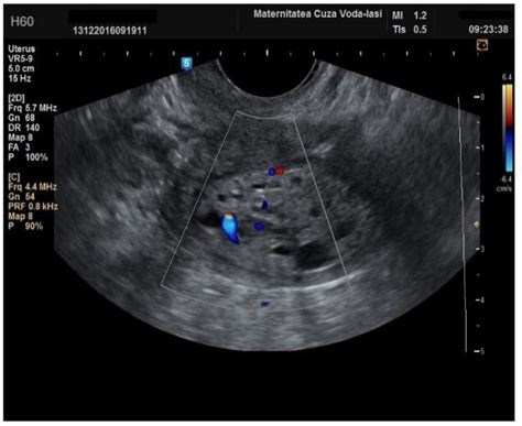 The Role Of Ultrasound In Diagnosing Endometrial Pathologies Adherence