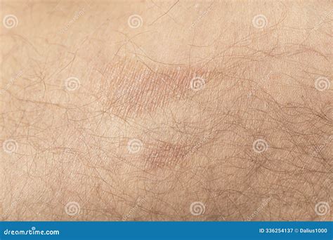 Large Plaque Parapsoriasis On Caucasian Man Legs Stock Image Image Of