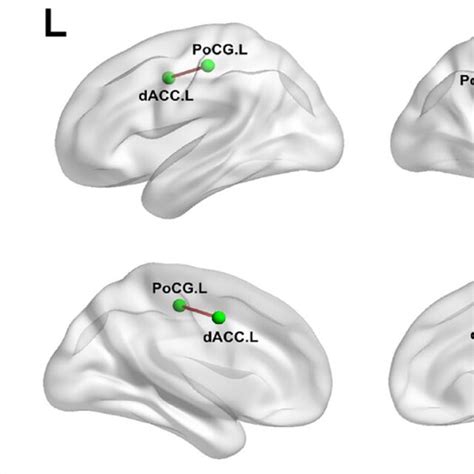Brain Regions With Group Differences In Global Resting State Functional Download Scientific