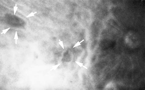 Choroidal Abnormalities In Neurofibromatosis Type 1 With Non Invasive Infrared Imaging British