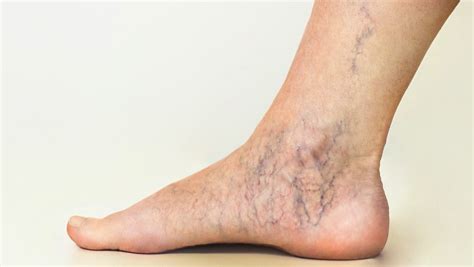 What Are Leg Spider Veins In Dubai And What Is Your Skin Is Telling You Vascular And Veins Care