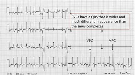 Lecture 20 Ventricular Conduction Delay And Miscellaneous Flashcards