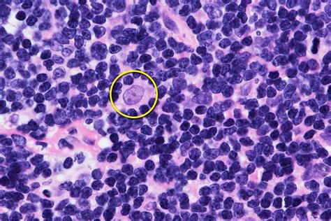 Mantle Cell Lymphoma Mcl Causes Symptoms Treatment And More