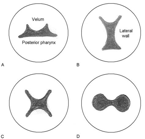 Velopharyngeal Port
