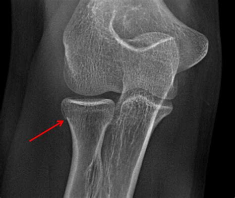 Occult Radial Head Fracture Feetincredible