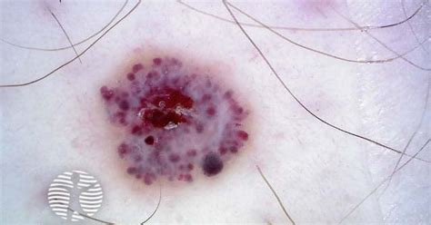 Dermoscopy Red Clods Angioma Image