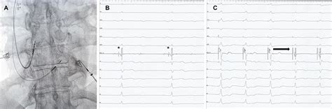 Feasibility Of Permanent His Bundle Pacing Cia