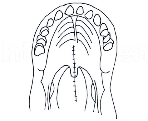 Two Soft Palate Flaps Used To Cover Raw Tissue Of Pharyngeal Flap Are Download Scientific