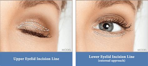 Upper Blepharoplasty Incision