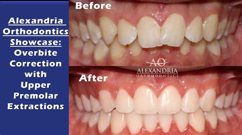 Alexandria Orthodontics Showcase Overbite Correction With Upper First