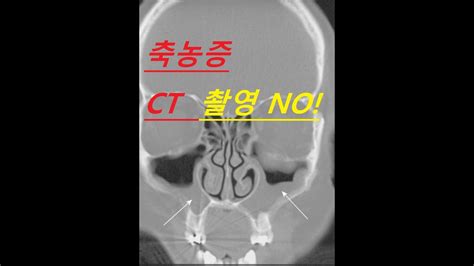 울산축농증 축농증부비동염 Ct 촬영 No Ct는 엑스레이 방사선 50~100배 노출 미국 알러지 천식 면역학회 자료 Youtube