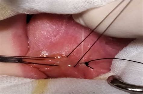 Modified Micro Marsupialization Technique Download Scientific Diagram