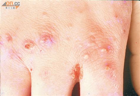 內地港童患疥瘡個案增 東方日報