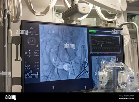 Istanbul Turkey February 29 2024 X Ray For Valvular Replacement With