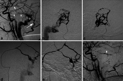 A 26 Year Old Woman With A Right Transverse Sinus Davf A Dsa Right