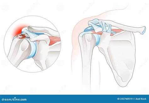 Ilustración Calcifica Tendinitis En El Hombro Etiquetado Stock De