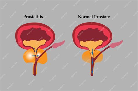 Diagnosing Prostatitis Urine Vs Prostate Culture Yleav