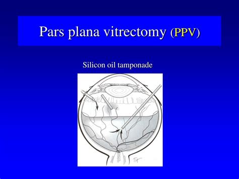 Ppt Vitreoretinal Diseases Anatomy Detachment And Therapy Powerpoint