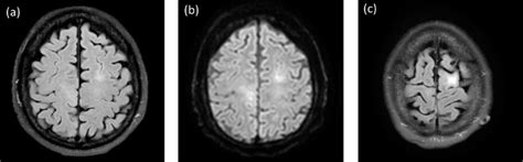Refractory Hhv 6 Encephalitis In A Patient Treated With Anti Cd20