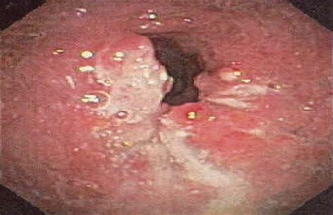 Topical Mitomycin C Is An Effective Adjunct Therapy For The Journal Of Bronchology