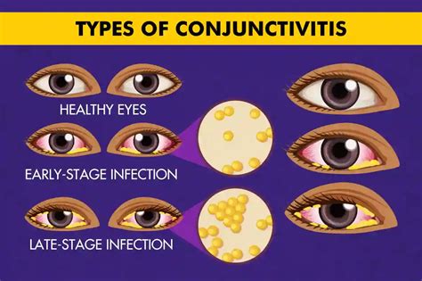 Types Of Conjunctivitis Centre For Sight