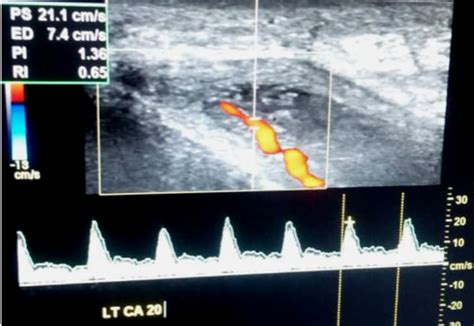 B Figures 3a And 3b Triplex Doppler Waveforms Of The Right And Left