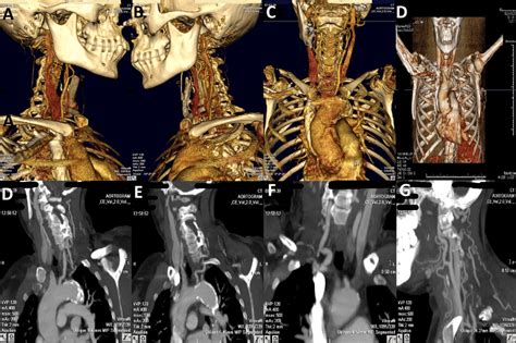Computed Tomography Ct Aortogram Of Chest Download Scientific Diagram