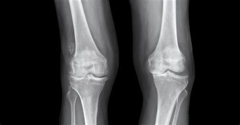 Do Not Overlook Knee Crepitus It Can Be Treated Bangkok International Hospital Brain X Bone