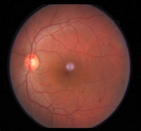 Normal Fundus Of Left Eye Download Scientific Diagram