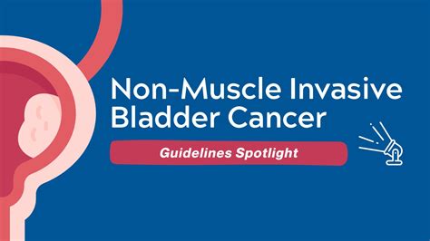 Diagnosis And Treatment Of Non Muscle Invasive Bladder Cancer