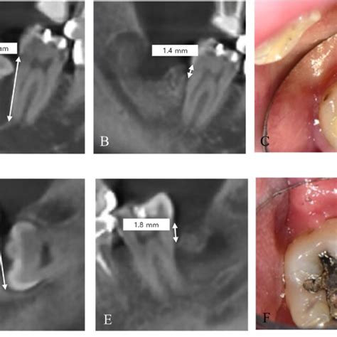 Measurement Of Bony Defect At The Distal Aspect Of The Adjacent Second Download Scientific