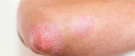 Guttate Psoriasis
