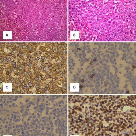 Hematoxylin And Eosin Staining Analysis A The Tumor Is In Diffuse