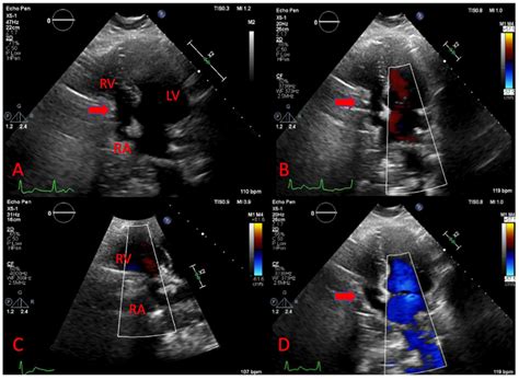Echocardiogram Showing Right Atrial And Ventricular Collapse After