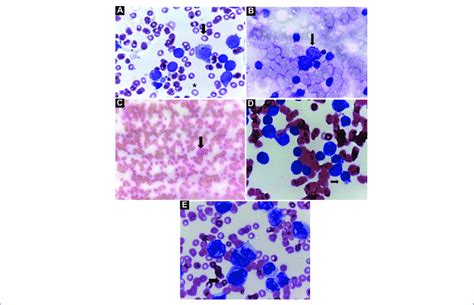 A Bone Marrow At Diagnosis Which Is Characterized By Megaloblastic