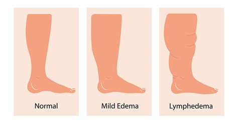 Understanding The Stages Of Lymphedema In The Legs