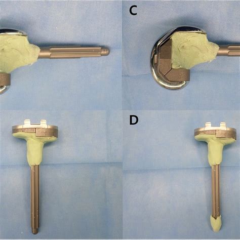 Two Types Of Cementing Technique For Femoral And Tibial Stem Fixation